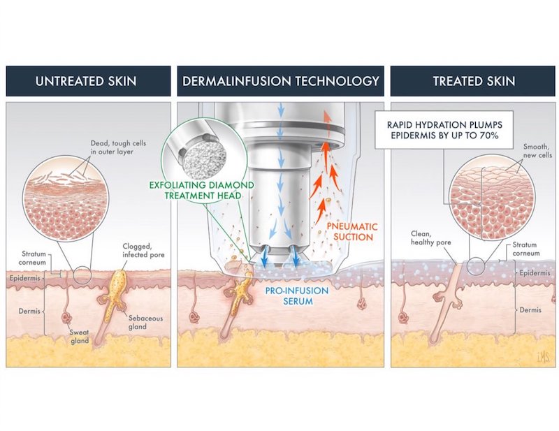 Dermal Infusion Facial Montgomery AL | DiamondGlow Montgomery AL