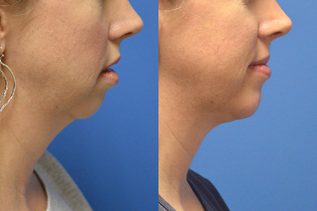 Facial Implants, Chin Augmentation / Reduction Before & After