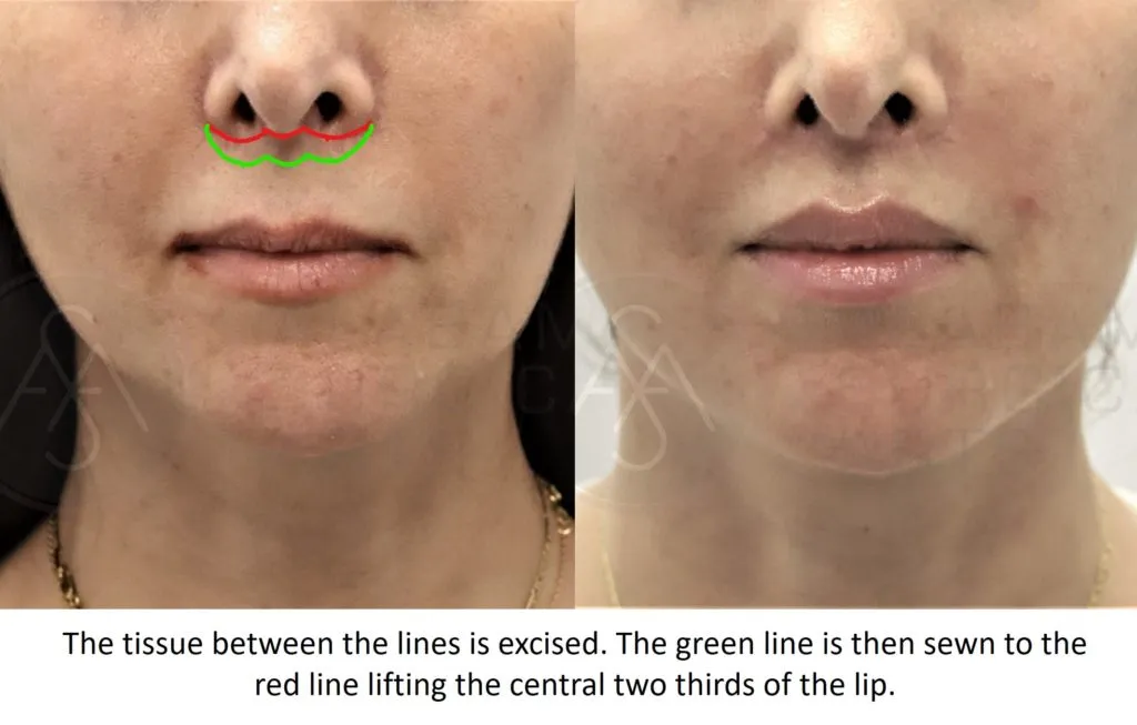 Lip Lift Montgomery AL | Bullhorn Lip Lift | Alabama Surgical Arts