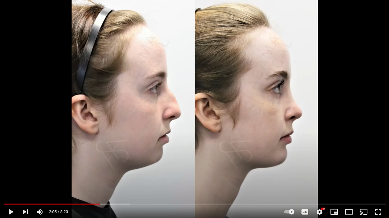 Genioplasty Montgomery AL | Chin Augmentation | Chin Reduction