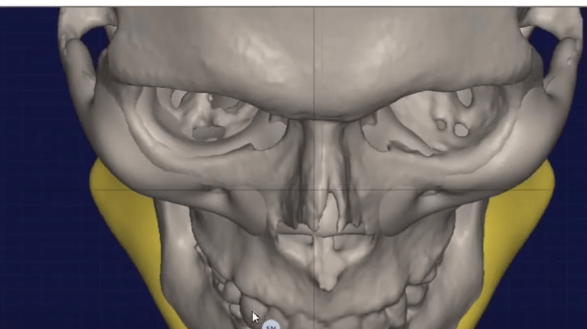 Genioplasty Montgomery AL | Chin Augmentation | Chin Reduction