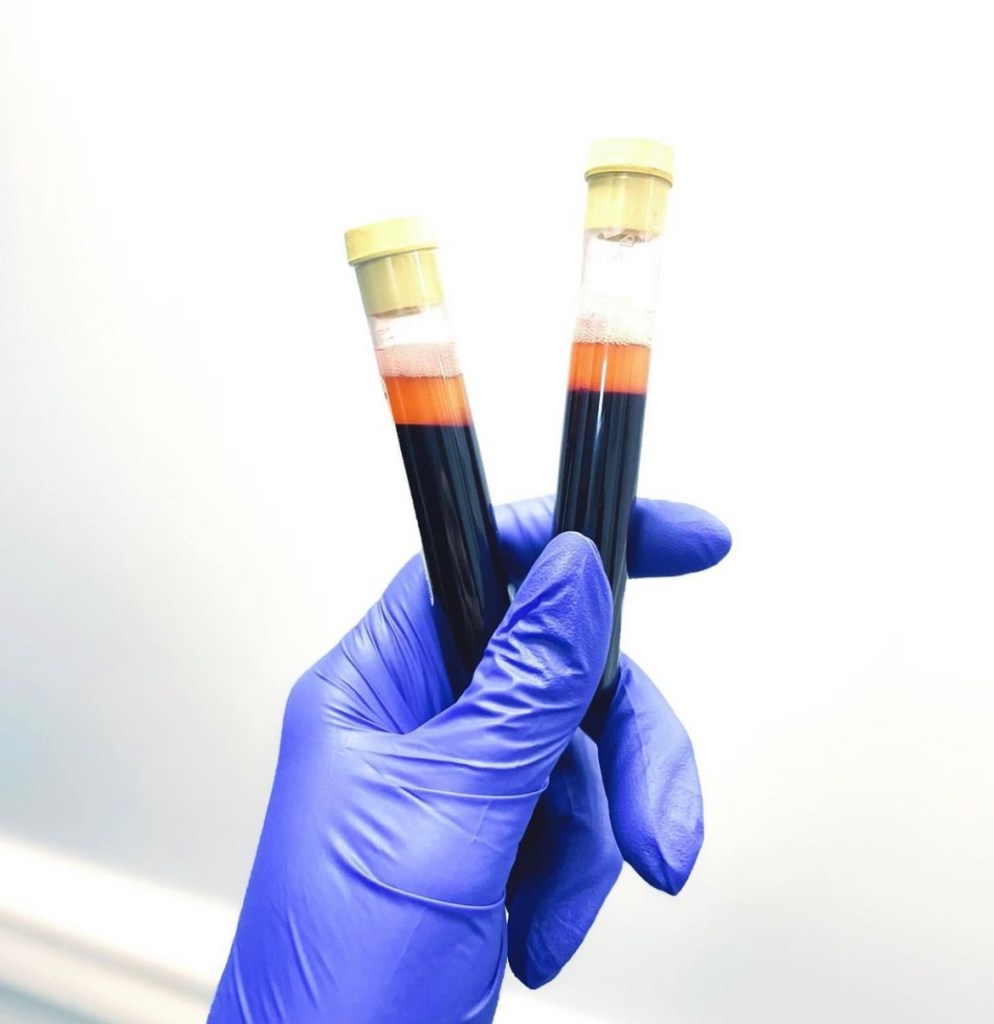 PRF Hair Injections Montgomery AL | Hair Rejuvenation Montgomery AL