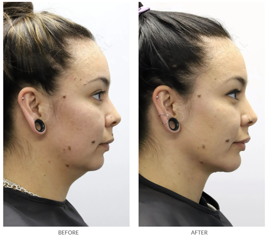 Neck Rejuvenation Guide