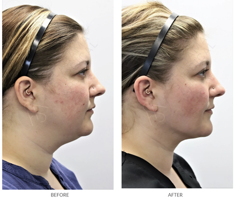 Neck Rejuvenation Guide