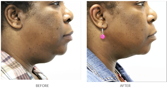 Neck Rejuvenation Guide