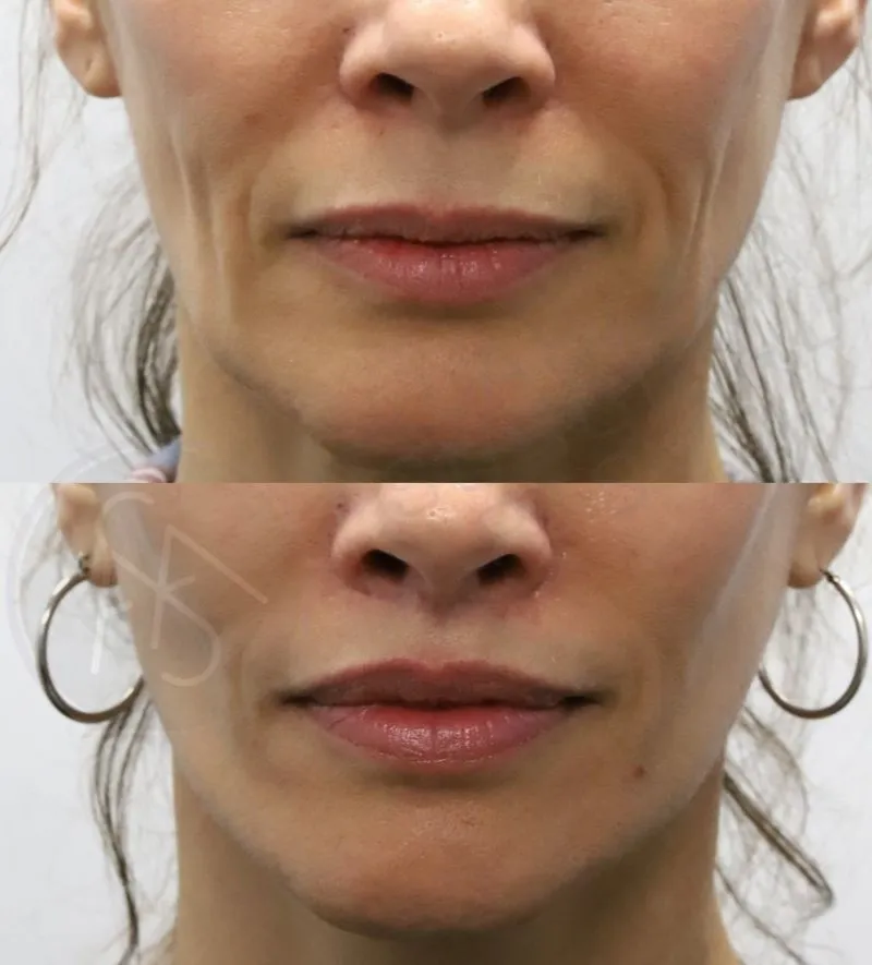 Lip Flip, Lip Filler, or Lip Lift – Which is Right for Me?