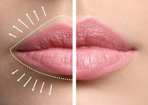 Lip Flip, Lip Filler, or Lip Lift – Which is Right for Me?